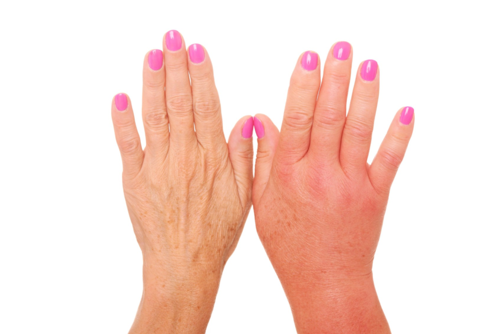 Thoracic Sympathetic RFA - Mitigate Pain Clinic - Dr Jeshnu Tople ...