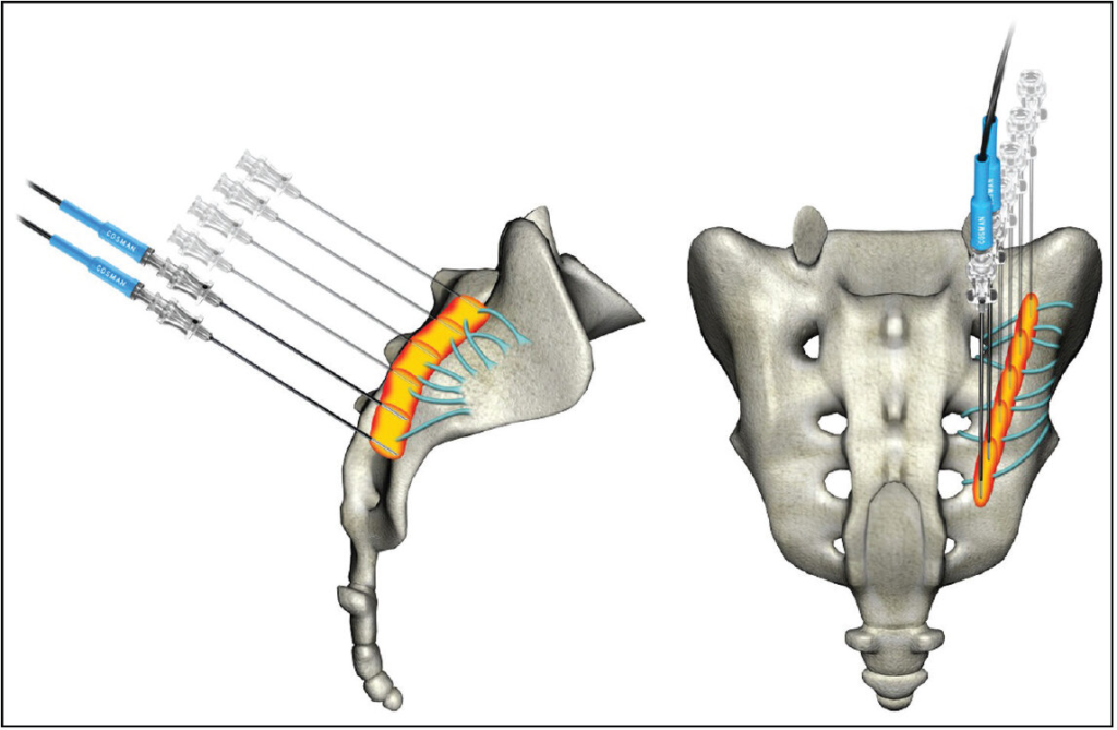 Sacroiliac Joint Injection and RFA for Back Pain - Mitigate Pain Clinic ...